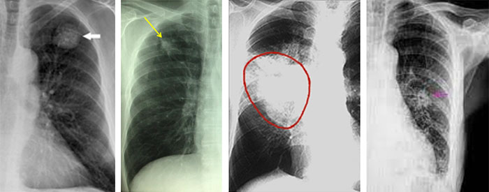 Tumor, câncer de pulmão/pulmonar - Oncologia do tórax