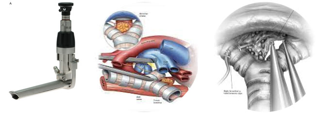 Tumor, câncer de pulmão/pulmonar - Oncologia do tórax