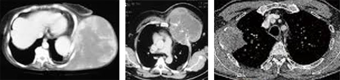 Tumor da parede torácica - Oncologia do tórax