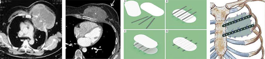 Tumor da parede torácica - Oncologia do tórax