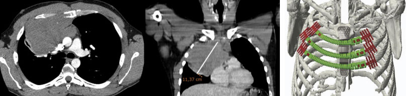 Tumor da parede torácica - Oncologia do tórax